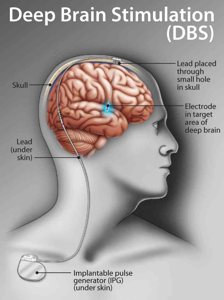 The Role of Neurosurgery in Epilepsy Surgery Management and Seizure Control
