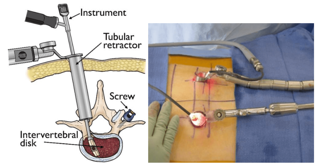 Minimally Invasive Spine Surgery for Slipped Discs | Advantages and ...